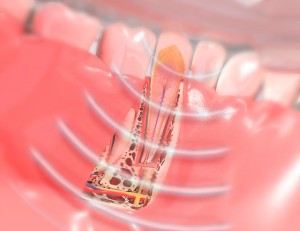 Faster Invisalign in half the time? Acceledent | Enhance Dental